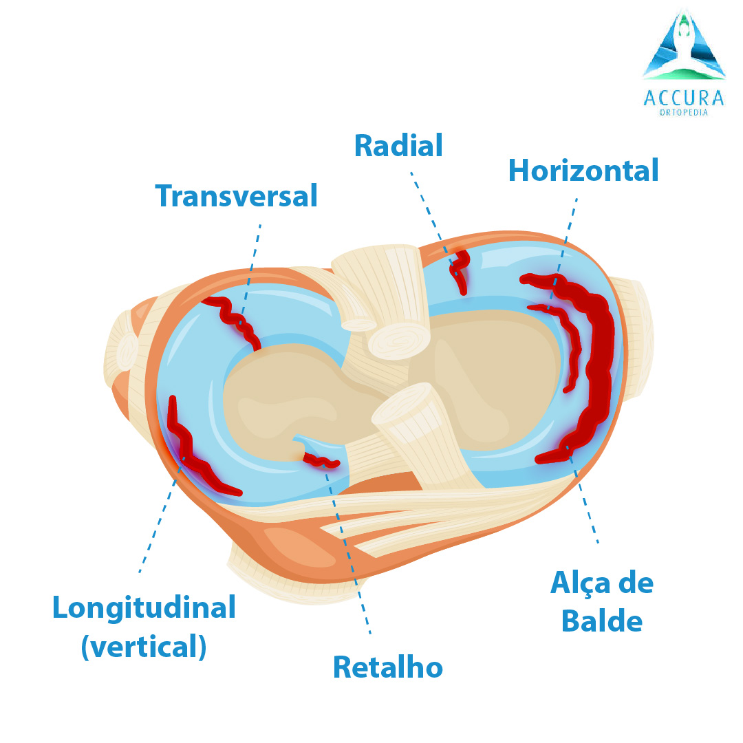 Lesão de Menisco – Accura Ortopedia